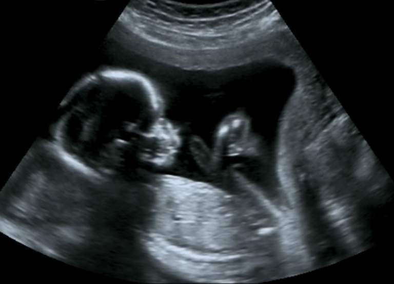 Tips Sebelum Ultrasound Scan Baby Untuk Lawatan Yang Lancar
